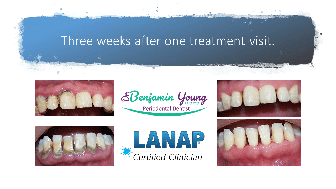Gum Disease Treatment - Dr. Benjamin Young MS DDS